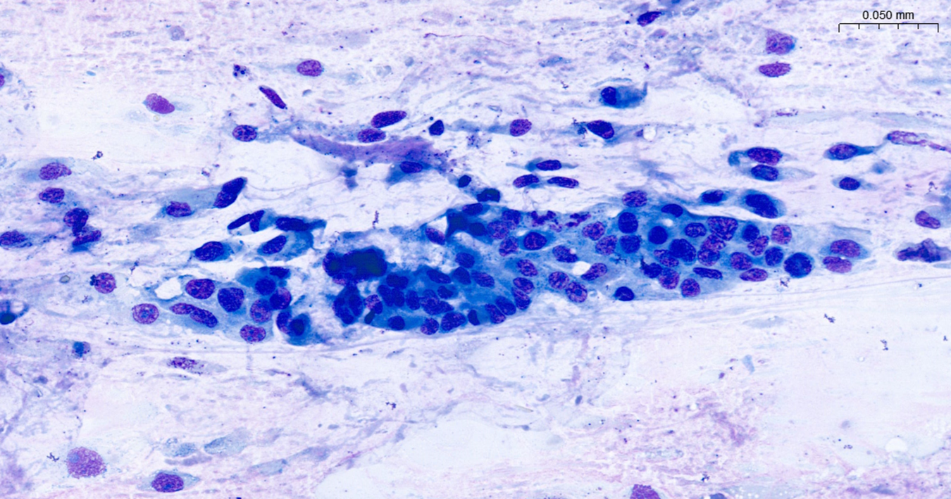 The Spindle Cell Dilemma and the Importance of the Follow-up Biopsy ...