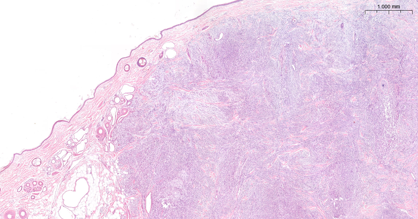 The Spindle Cell Dilemma and the Importance of the Follow-up Biopsy ...